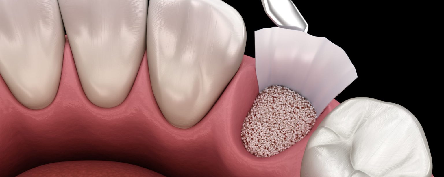 Torrance Bone Grafting for Dental Implants | Palos Verdes Sinus Lifts