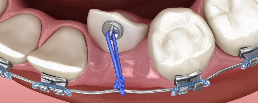Torrance CA Impacted Canine Teeth Surgery, Treatment | Palos Verdes
